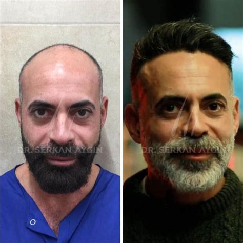 Haartransplantation in der Türkei auf Erfolgskurs