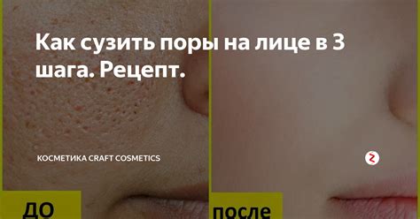 Расширенные поры очень заметны и портят внешний вид. Причиной может ...