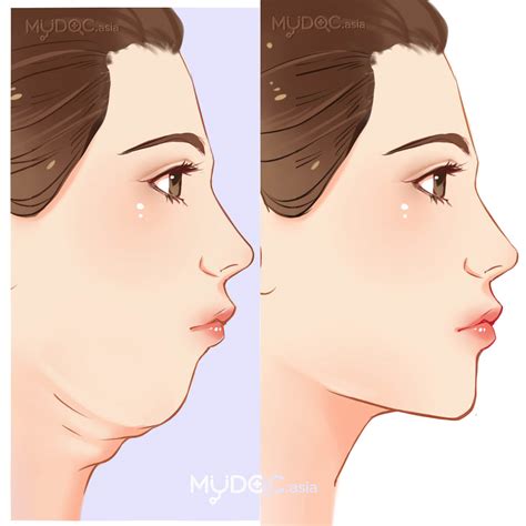 Best Double Chin Treatment In Johor Bahru Johor