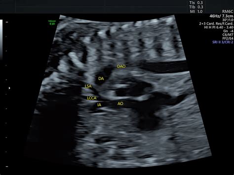 Sonograms Of The Fetus Of Coarctation Of The Aorta At The Sagittal