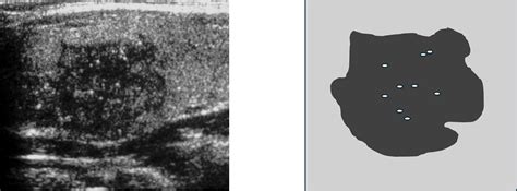 Ata 2026 Sonographic Classification And Assessment Of Thyroid Nodules