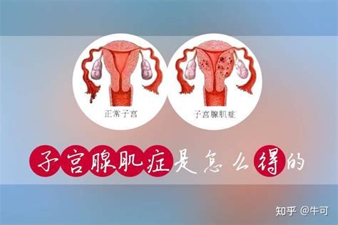 子宫腺肌症病因 知乎