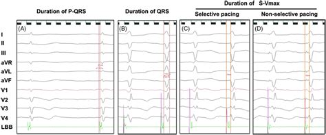 The Basic Criteria Of Left Bundle Branch Area Pacing Lbbap A P