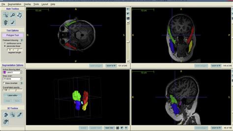 Opening Screen Of The Itksnap Software Showing Multiple Planar Views