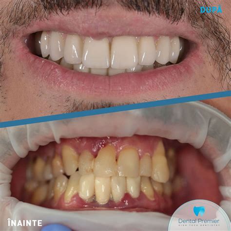 Proteza Dentara Kemeny Tipuri Avantaje Preturi Dental Premier