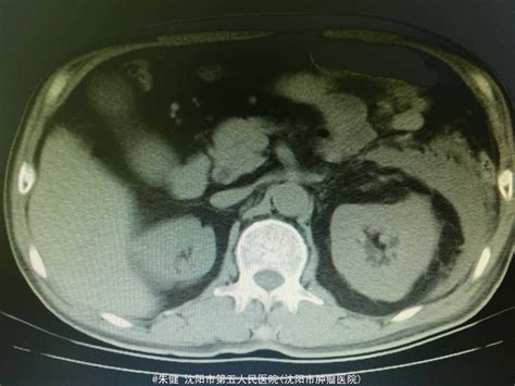 急性胰腺炎一例