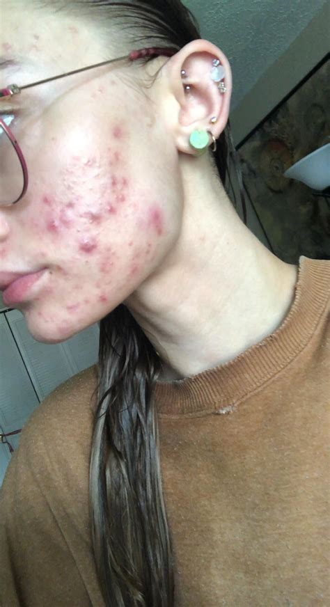 First Week Of Purging On Differin Gel R Acne
