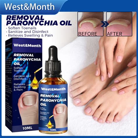 Westandmonth Removal Paronychia Oil Ingrown Toenail Treatment Nail Repair Anti Fungal Soften