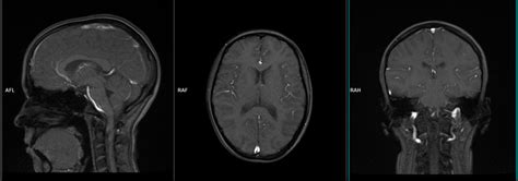 Cerebrospinal Fluid Flow MRI CSF Flow MRI Protocol And Planning