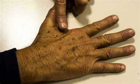 Câncer De Pele Com A Chegada Do Verão Prevenção é Fundamental Para