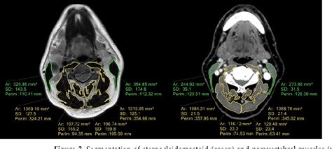 Figure 1 From Skeletal Muscle Depletion And Major Postoperative