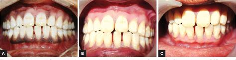 Figure 1 From Esthetic Management Of Melanin Hyperpigmentation Using Diode Laser A Report Of