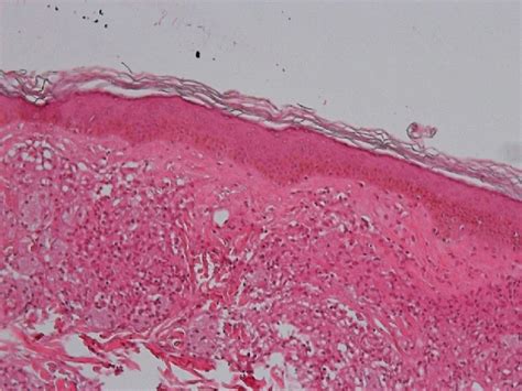 Leprosy An Update Definition Pathogenesis Classification Diagnosis