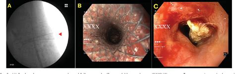 Figure 1 From Combined Eus Lams And Percutaneous Fully Covered Sems