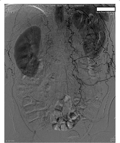 Angiogram Demonstrating Collateral Flow To The Lower Extremities From