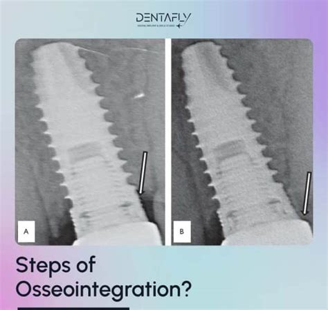 Osseointegration A To Z Overview Denta Fly