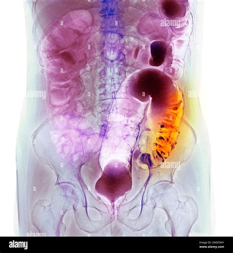 Contraste De Lavement Baryt Color Montrant Des Diverticules Coliques
