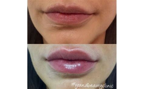 Injectare Cu 1 Ml Acid Hialuronic Princess Volume Buze Arhivat