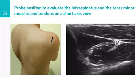 Muscloskeletal Ultrasound Of The Shoulder Basic Level Pptx