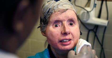 Us Woman Mauled By Chimp Shows New Face In First Photo