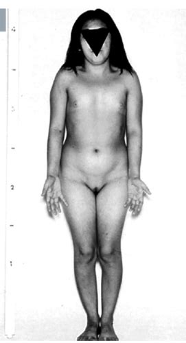 Disorders Of Sexual Development Flashcards Quizlet