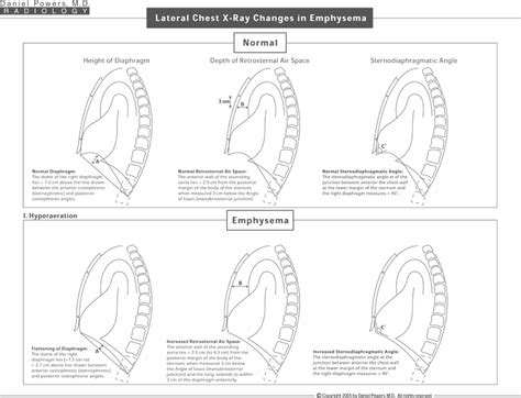 Emphysema Diagrams