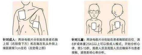 科普篇｜对于心脏骤停儿童电极片该如何贴 知乎