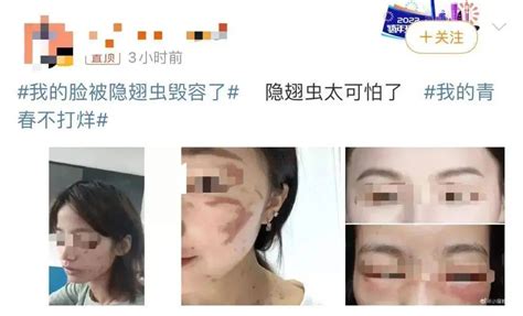 我的脸被隐翅虫毁容了登上热搜遇到千万别拍毒液堪比盐酸 皮肤 身体 眼睛