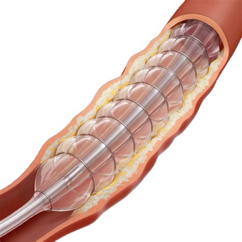 Chocolate™ Pta Balloon Catheter Percutaneous Transluminal Angioplasty