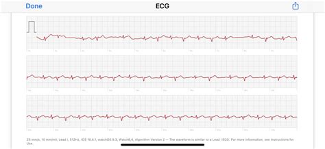 This Is What Bigeminy Pvcs Look Like On Apple Watch Ecg R Pvcs