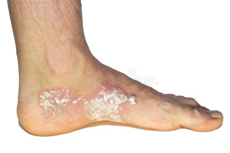 Closeup Of Psoriasis Vulgaris And Fungus On The Mans Foot Finger Nails With Plaque Rash And