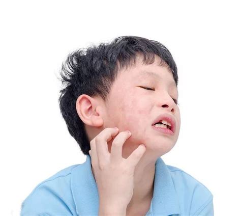 難怪你的濕疹、蕁麻疹久治不愈，教你1分鐘區別濕疹、蕁麻疹 壹讀