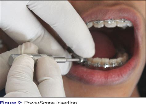Figure 1 From Powerscope A Class Ii Corrector A Case Report