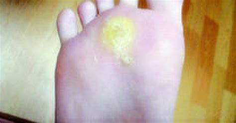 티눈 얕봤다간 피부궤양 된다