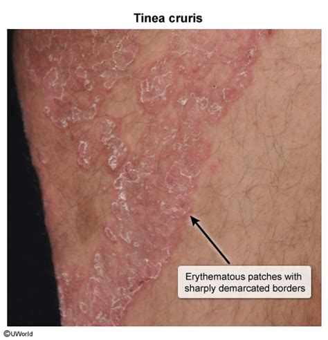 Dermatophyte Tinea Infections Dermatology Uworld Medical Library