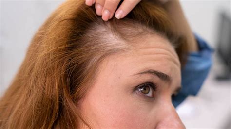 Female Pattern Baldness Causes Symptoms Types And Treatment