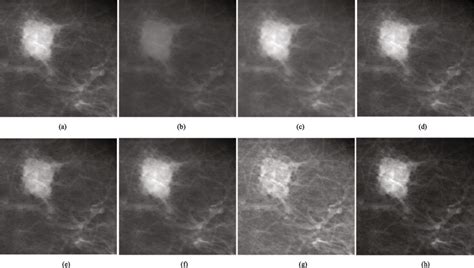 comparison of mammogram fusion results with different fusion