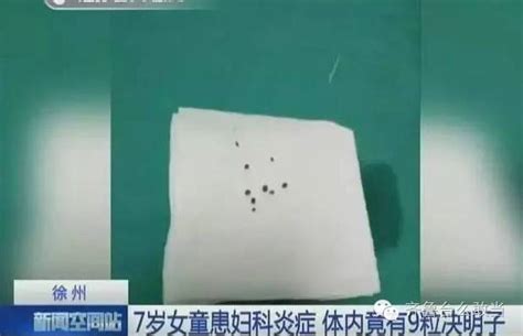 女生妇科病有哪些包皮尖锐湿疣 随意云