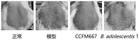 Bifidobacterium Adolescentis Capable Of Relieving Psoriasis And