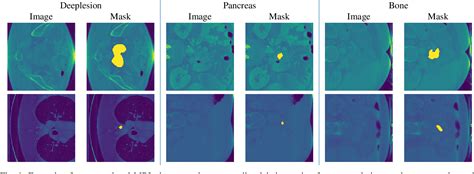 Figure 1 From Optimizing Universal Lesion Segmentation State Space
