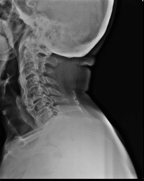 Dish Diffuse Idiopathic Skeletal Hyperostosis Spine Orthobullets