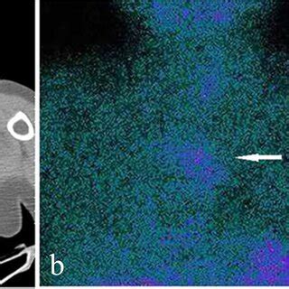 CT Imaging And Scintigraphic Analysis Using Technetium 99 M A A Mass Download Scientific