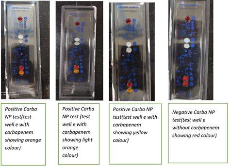 Comparison Of Three Phenotypic Methods Of Carbapenemase Enzyme