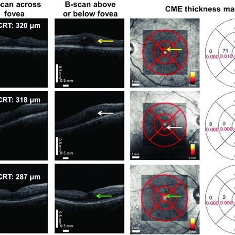Dme Cases With Observable Fluid In Cme Thickness Map And In B Scans Download Scientific