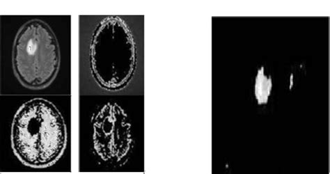 Figure 1 From An Automatic Brain Tumor Detection And Segmentation Using