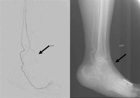 Angiogram Of Left Distal Leg And Foot Showing Poor F Low Of The Distal Download Scientific