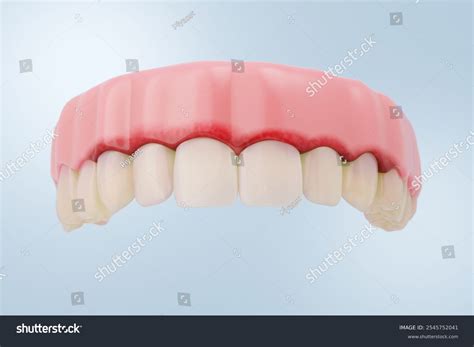 Inflamed Gums Showing Early Signs Gingivitis Stock Illustration