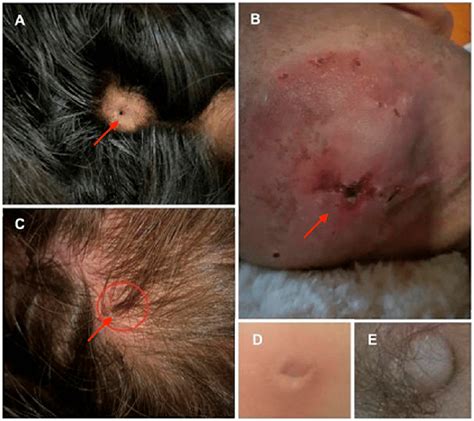 Scalp Lesions Suggestive Of Dermal Sinus A Specific Lesion In The Download Scientific Diagram
