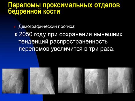 Рентгенодиагностика переломов проксимальных отделов бедренной кости