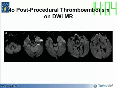 Adel Malek：neuroform Atlas支架在颅内动脉瘤治疗中的应用丨ocin2017精彩回顾 脑医汇